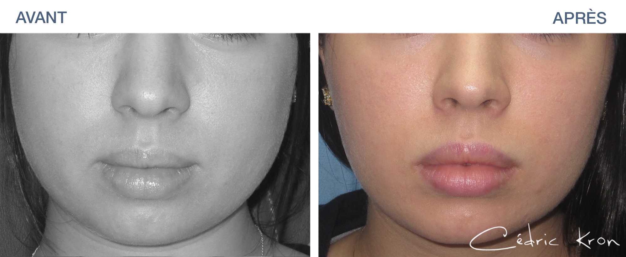 Before & After: Jaw reduction using Botox injections