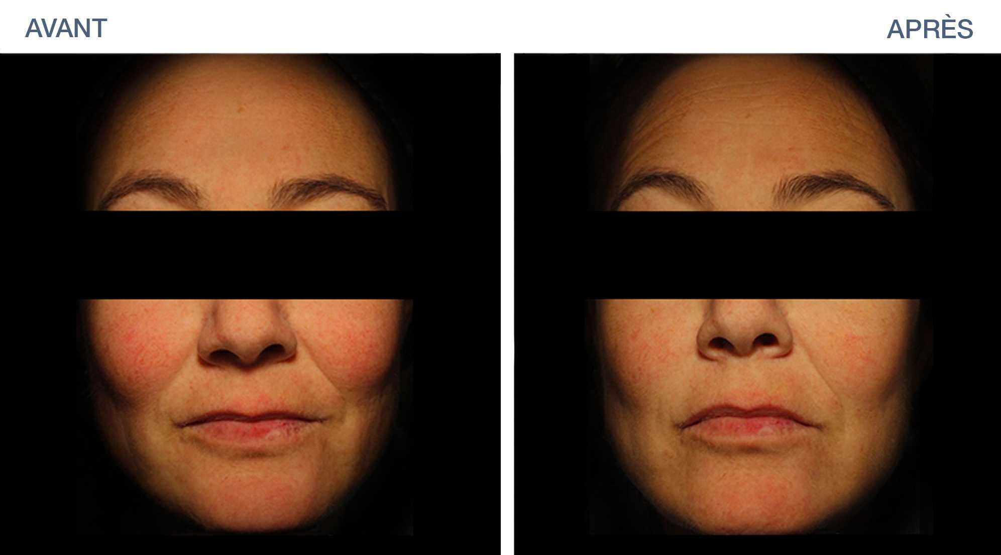 Couperose, rosacée et érythrose : Traitement au laser