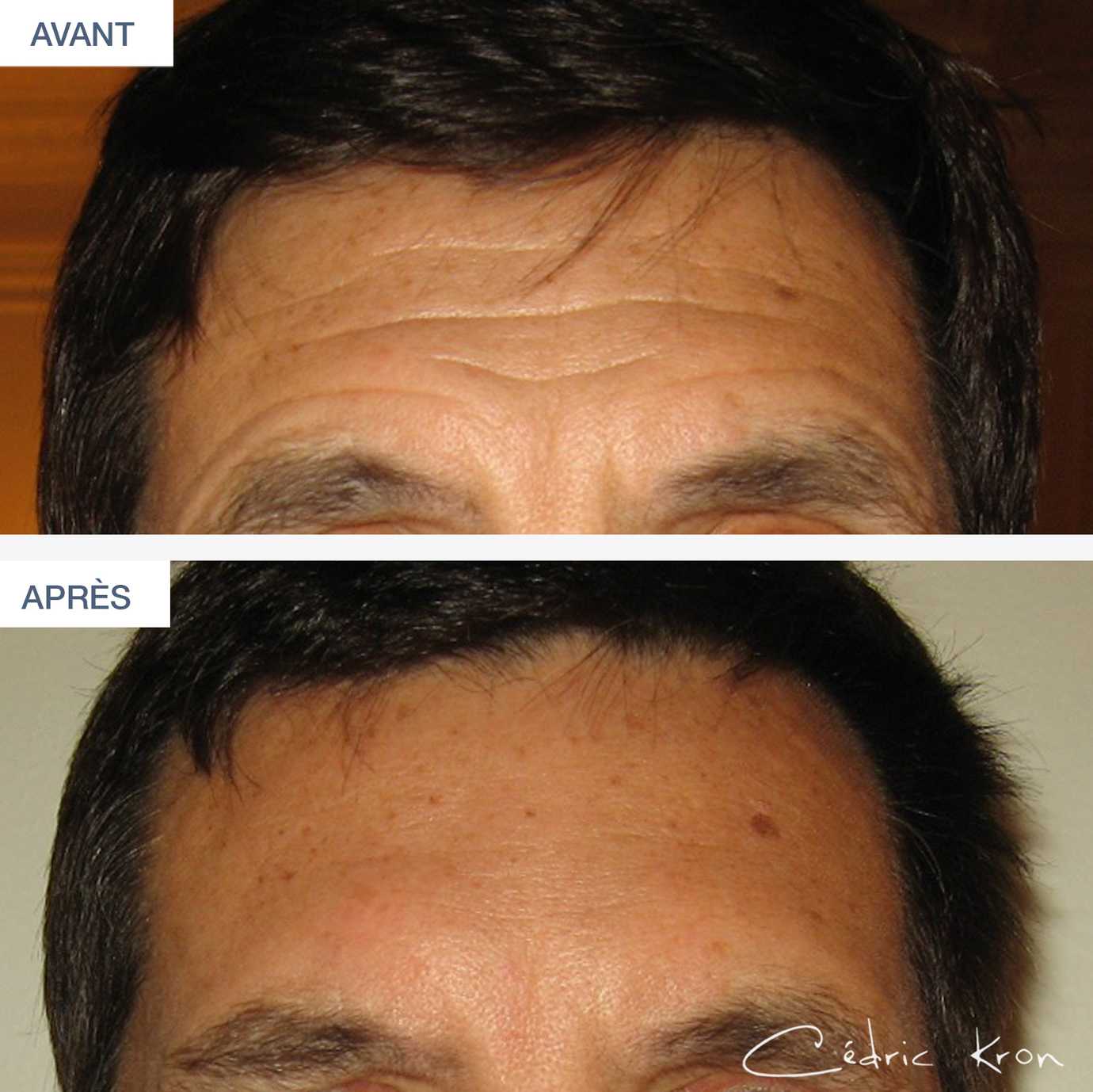 Comblement des rides du front par injections d'acide hyaluronique Comblement des rides du front par injections d'acide hyaluronique