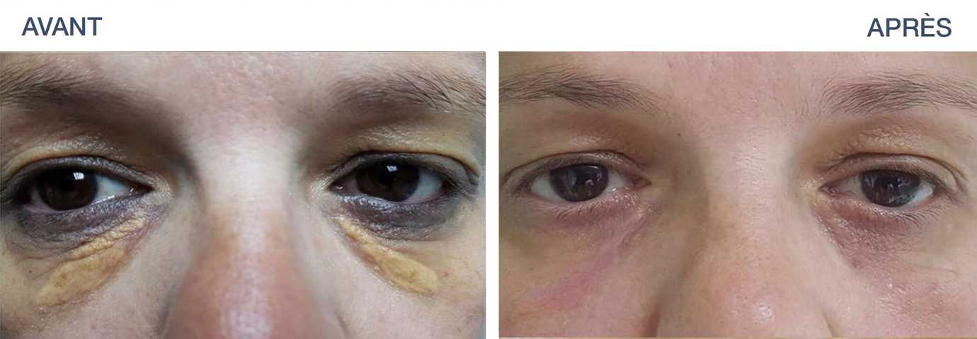 Plexr® à Paris : Traitement des paupières, des rides et des ...