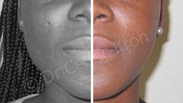 Before & After: Abdominoplasty or Tummy tuck | Dr Cédric Kron