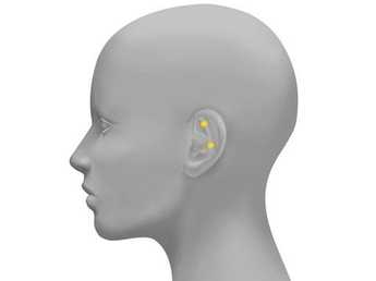 EarFold implants : Prominent ears treatment with a short recovery
