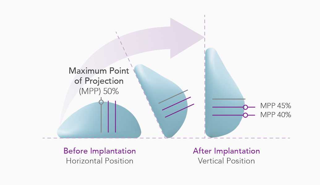 Implants Ergonomix2® : Un résultat toujours plus naturel avec une ...