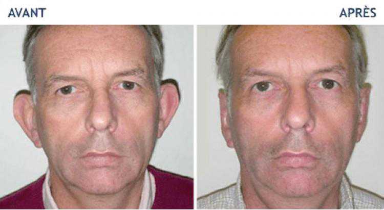 Avant-après : Correction des oreilles décollées avec implants earFold