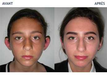 EarFold implants : Prominent ears treatment with a short recovery