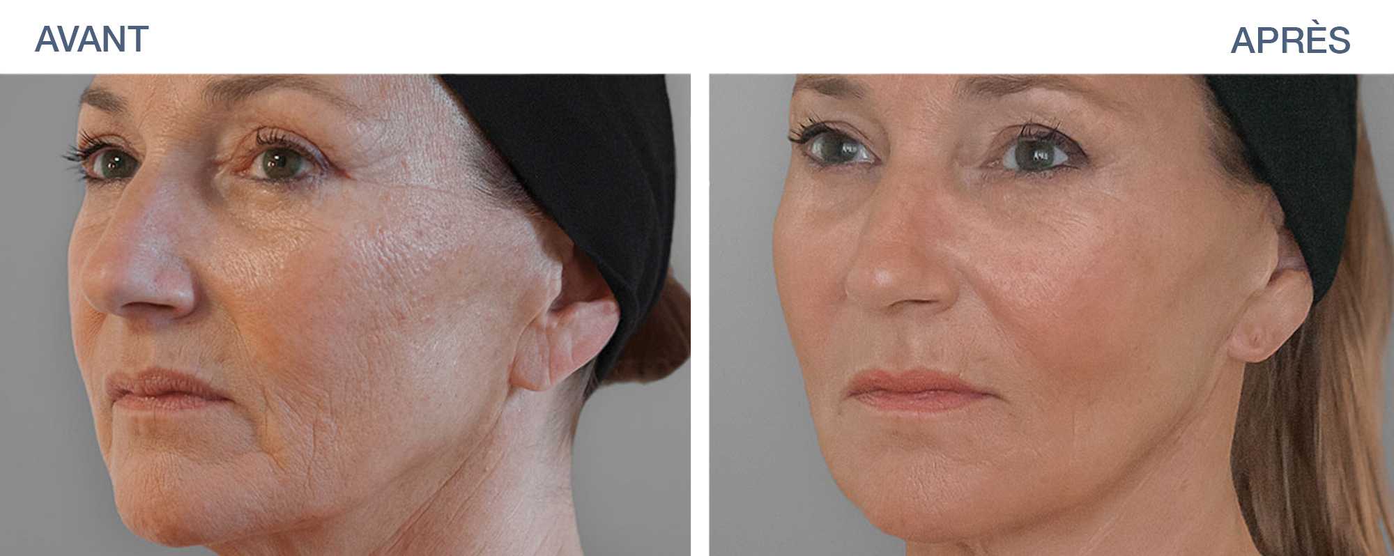 Injections d'ELLANSÉ® à Paris - Dr Cédric Kron