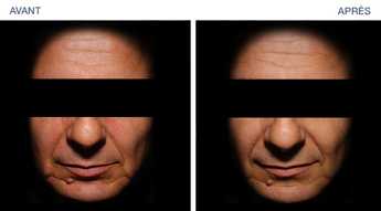 Couperose, rosacée et érythrose : Traitement au laser