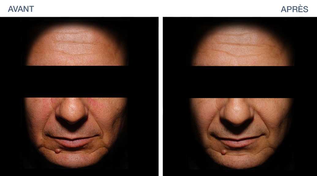 Couperose, rosacée et érythrose : Traitement au laser