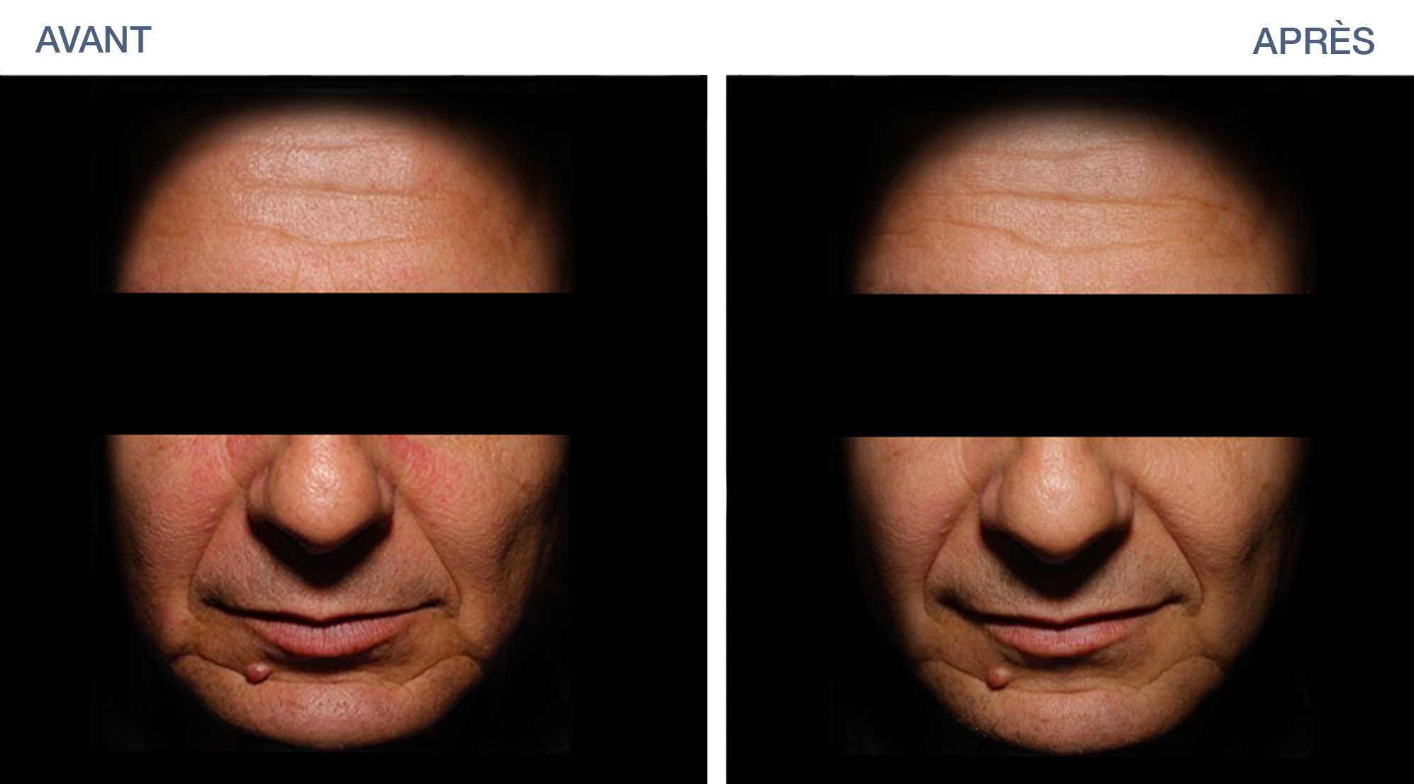 Couperose, rosacée et érythrose : Traitement au laser