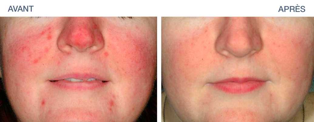 Couperose, rosacée et érythrose : Traitement au laser