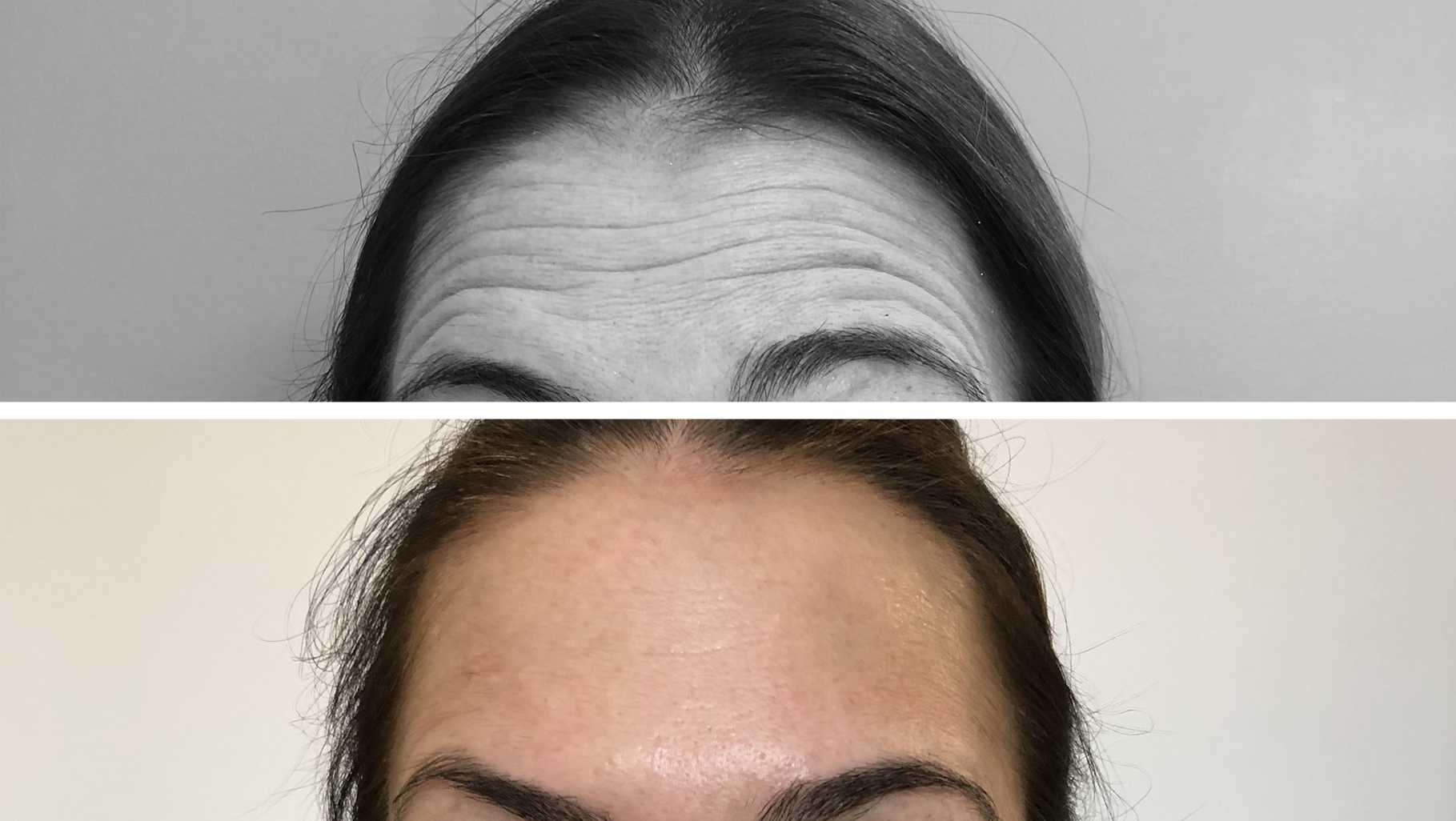 Photos avant-après de chirurgie esthétique | Dr Cédric Kron