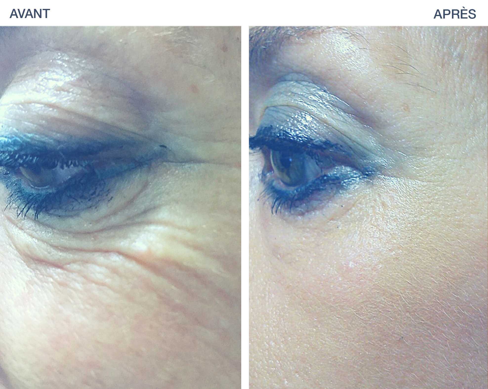 Plexr® à Paris : Traitement des paupières, des rides et des ...