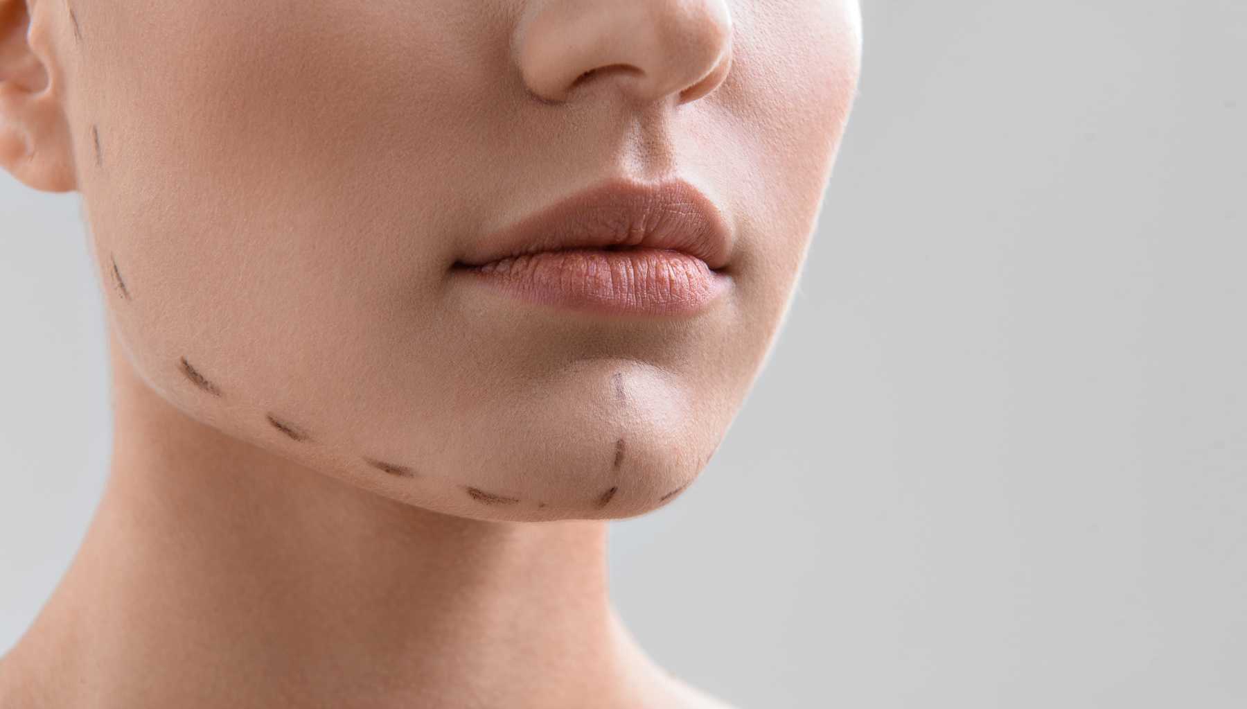 Génioplastie : Chirurgie esthétique du menton fuyant ou saillant à Paris