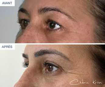 Avant-après de blépharoplastie : chirurgie des paupières | Dr Kron