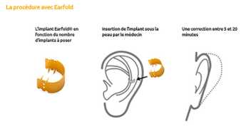 EarFold implants : Prominent ears treatment with a short recovery
