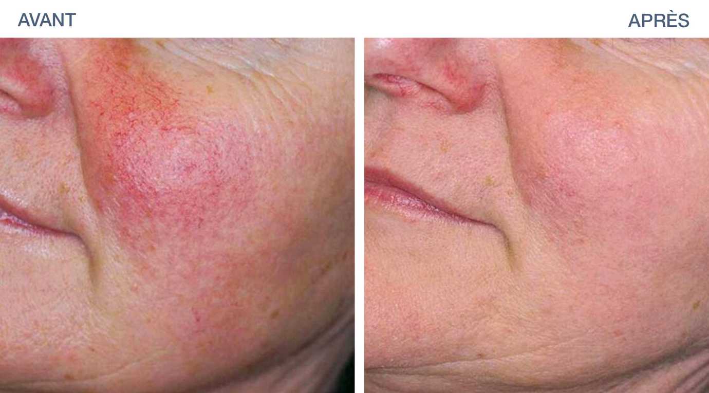 Avant-après : Traitement de la couperose, rosacée et érythrose