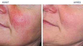 Avant-après : Traitement de la couperose, rosacée et érythrose