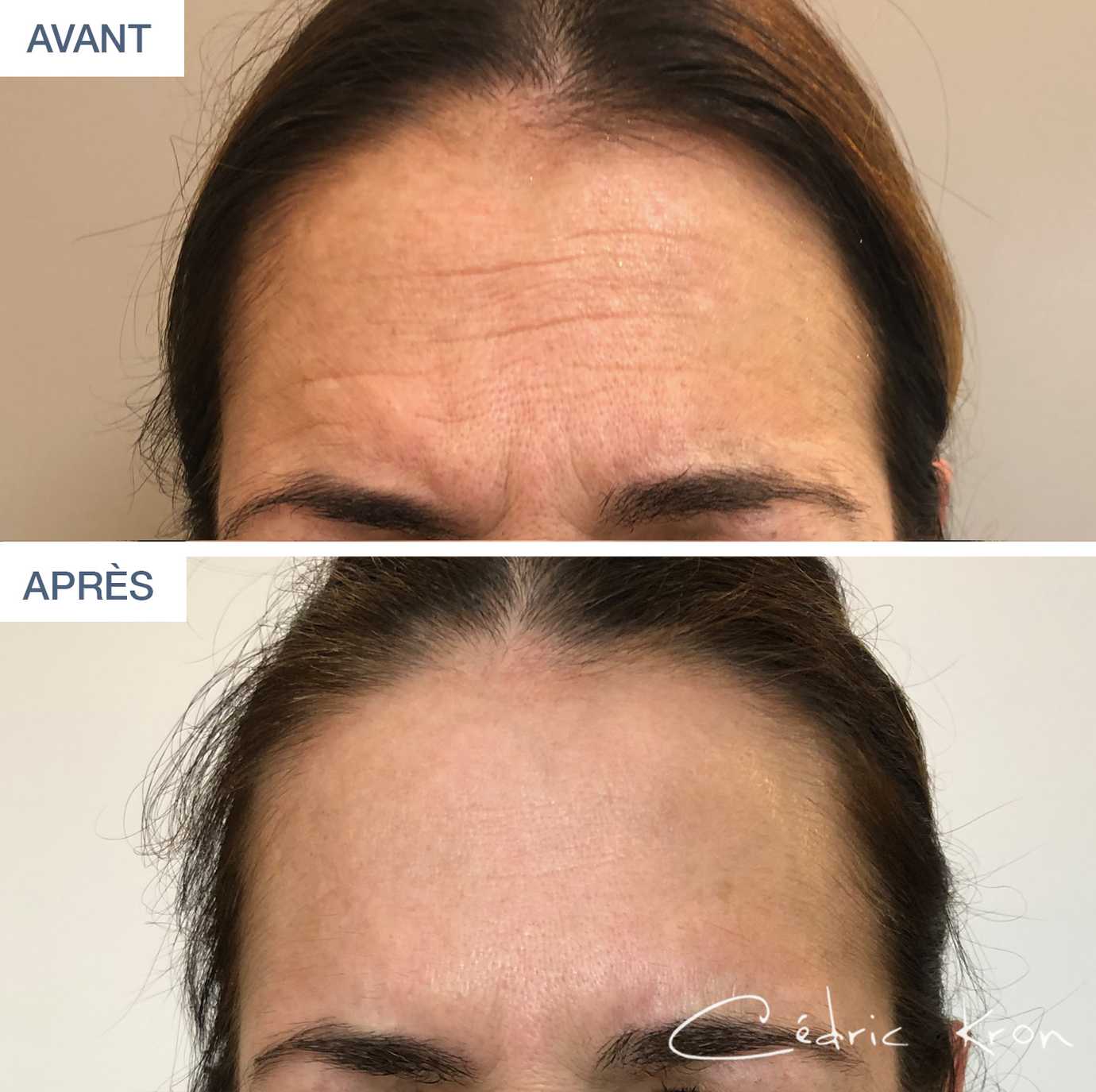 Avant-Après : Traitement des rides du front par botox