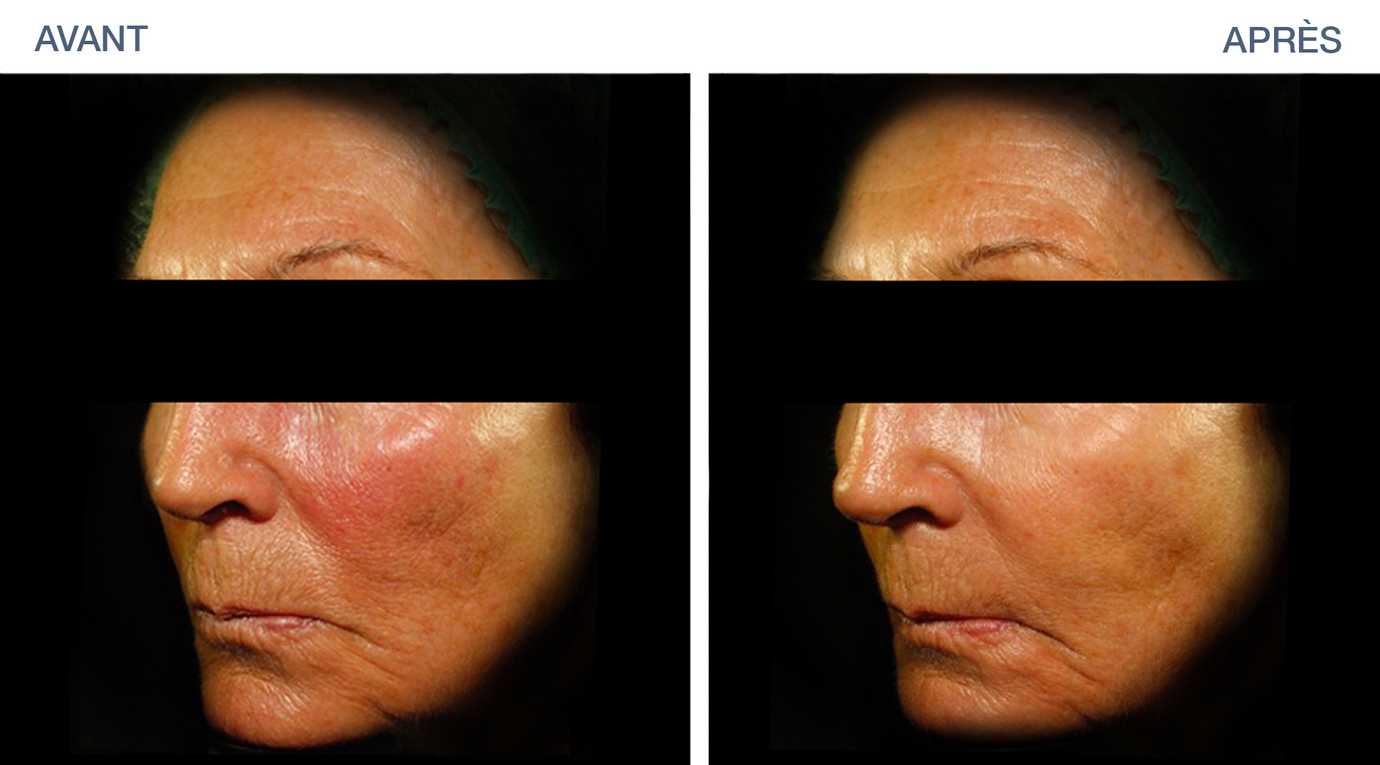 Couperose, rosacée et érythrose : Traitement au laser