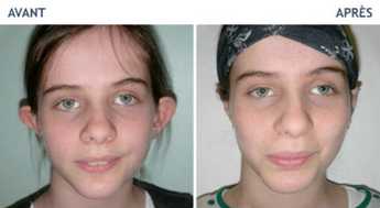 Before & After: prominent ears correction