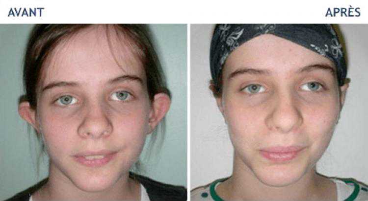 Avant-après : Correction des oreilles décollées avec implants earFold